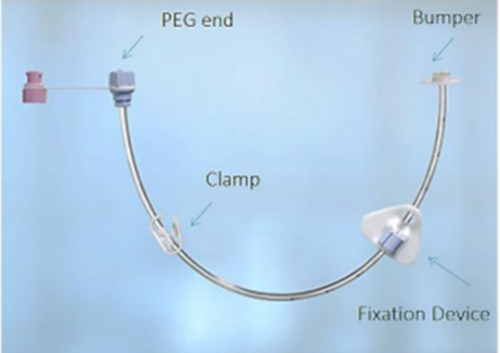 PEG, PIGG and RIG | North Bristol NHS Trust